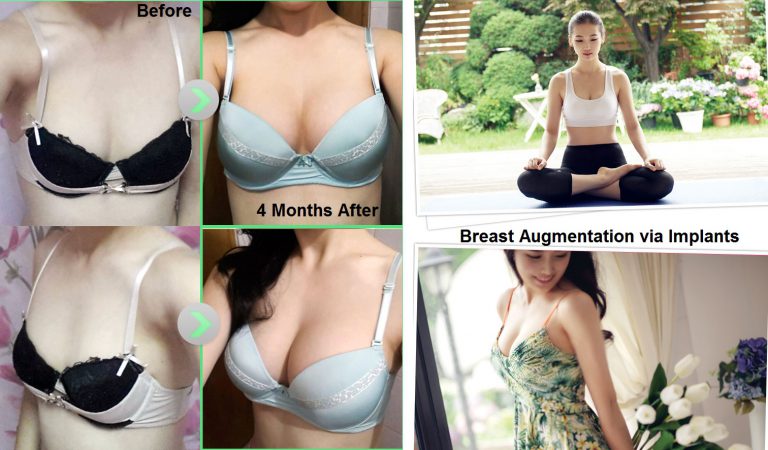 Breast Augmentation Incision Types Seoul Guide Medical